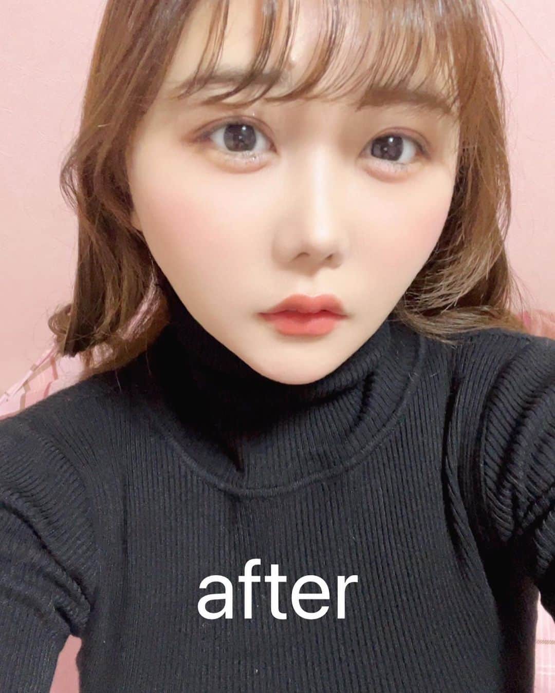 ななちゃさんのインスタグラム写真 - (ななちゃInstagram)「今日もお疲れ様ー！！💗🐰 先日、半年に一回 たるみ予防の為に行ってる 糸 ...