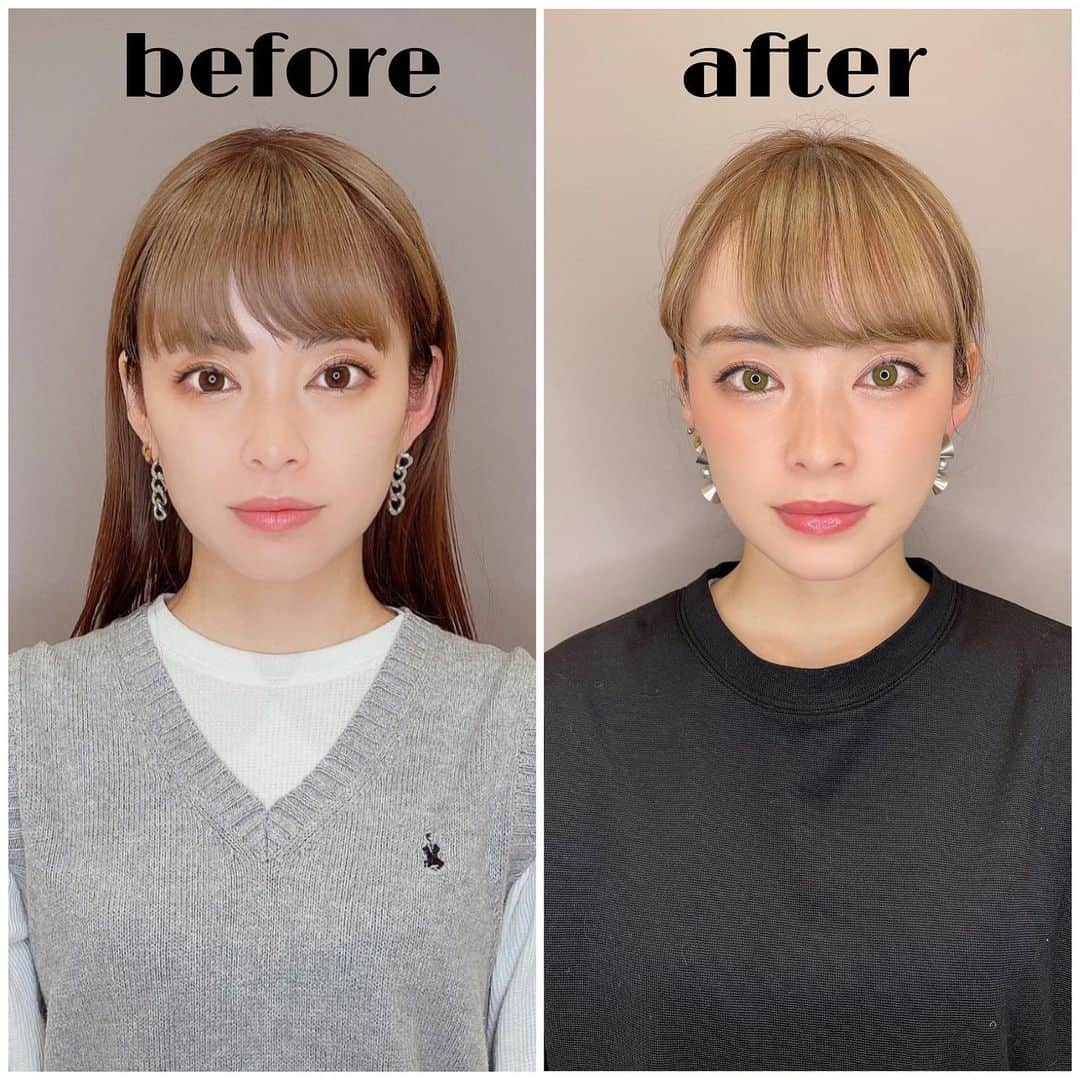 Sho Noさんのインスタグラム写真 Sho Noinstagram 「東京中央美容外科上野院 Tcb Ueno へ3度目の来院
