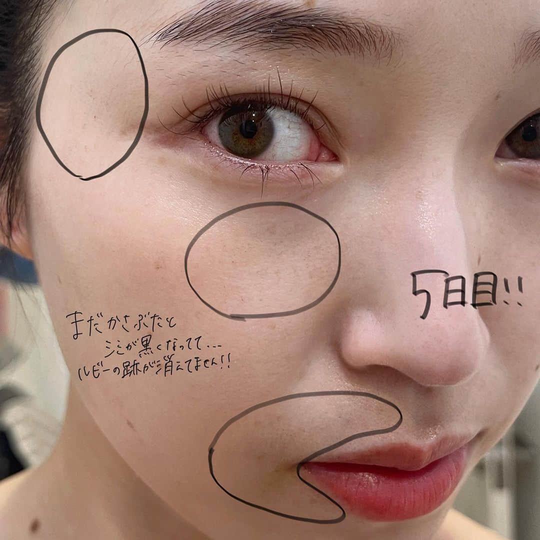 MANAE【Violet】さんのインスタグラム写真 - (MANAE【Violet】Instagram)「レーザーレポ🫶写真つき🤳 . @junclinicshirokane で3回目？の ...