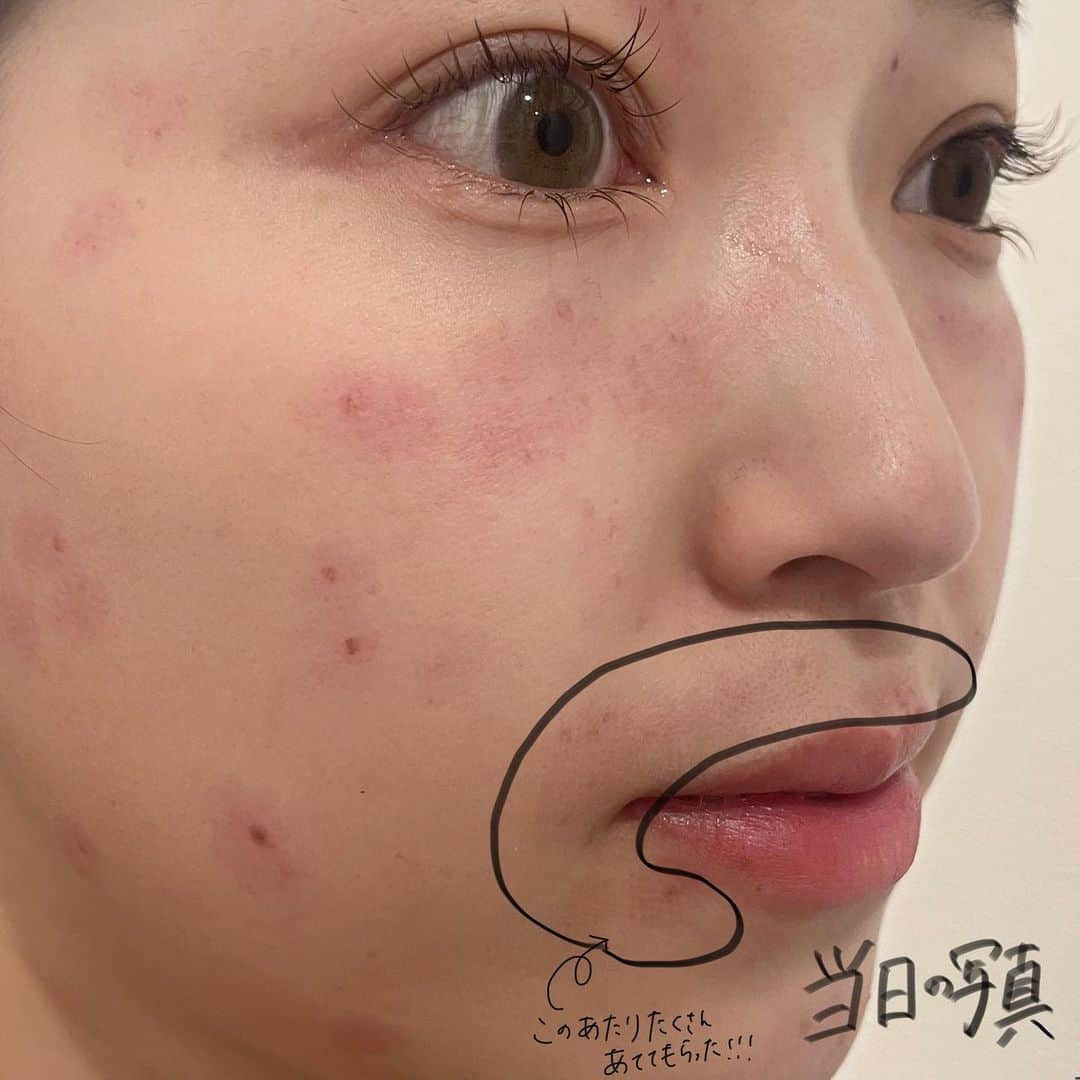 MANAE【Violet】さんのインスタグラム写真 - (MANAE【Violet】Instagram)「レーザーレポ🫶写真つき🤳 . @junclinicshirokane で3回目？の ...