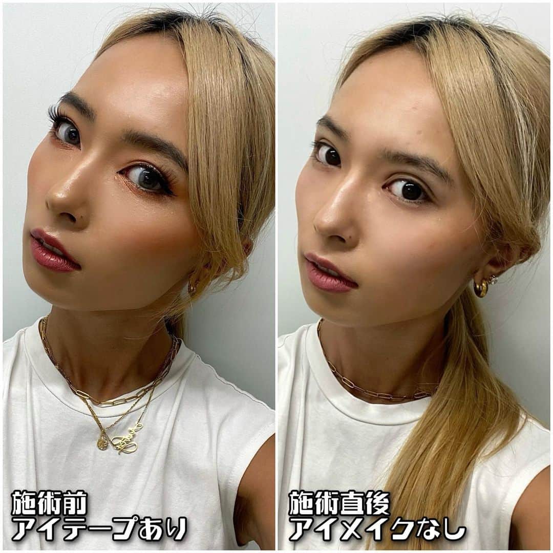 Ayaさんのインスタグラム写真 Ayainstagram 実は東京中央外科江坂院 Tcbesaka で Tcb式1dayクイックアイ